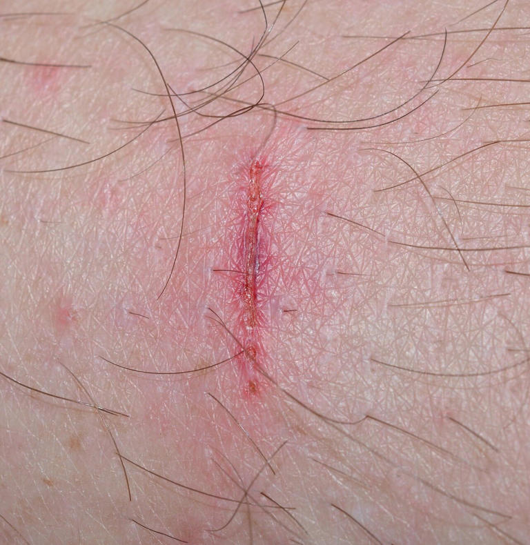 Smart wound dressing delivers antibiotics on-demand, accelerating ...