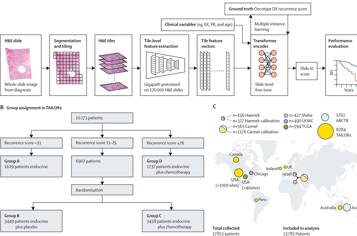 AI model can predict chemotherapy benefit in breast cancer