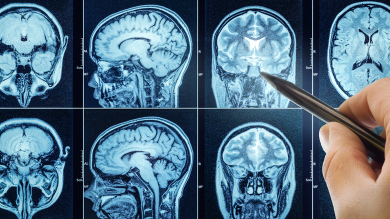 The final reflex doctors check before declaring brain death