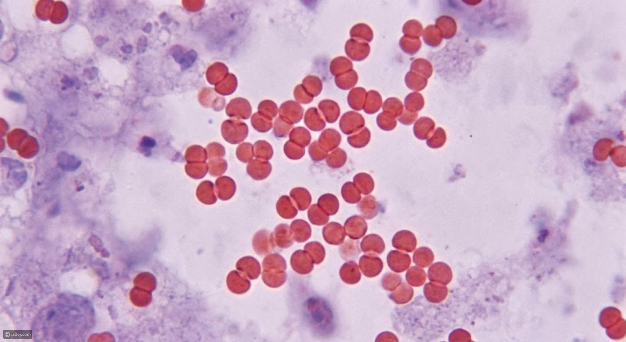 Meningitis B outbreak in the UK: What do we know about this disease?