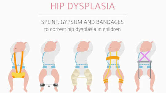 Varun Dhawan shares daughter’s developmental dysplasia of the hip ...