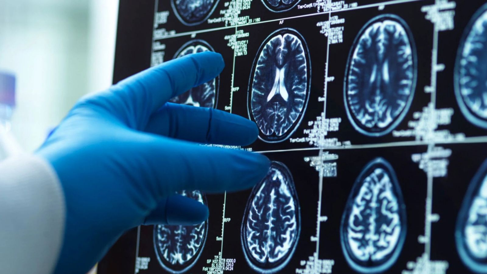 Discovery offers hope to children with rare and severe epilepsy