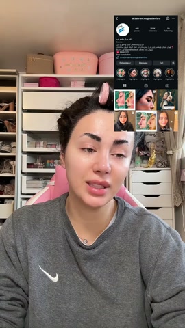 My 4-month revision nose job update and healing reality