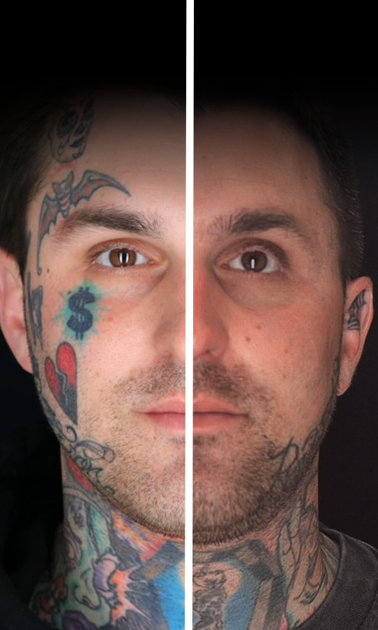 I want my face tattoo removed