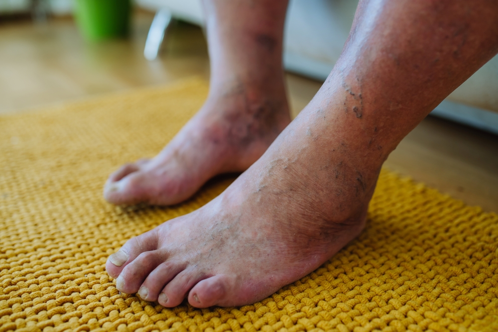 New Mexico is now the only state that makes insurers pay for diabetic ...