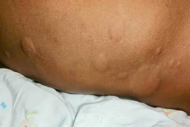Why you have hives on your stomach and how to ease the itch