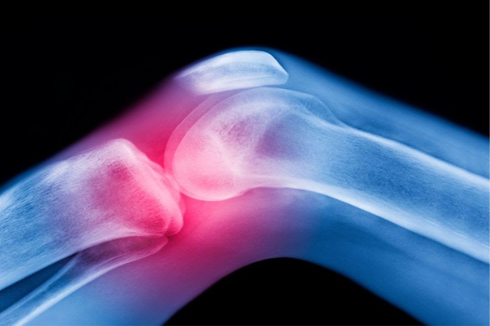 Osteoarthritis: Most effective therapies for pain relief revealed in ...