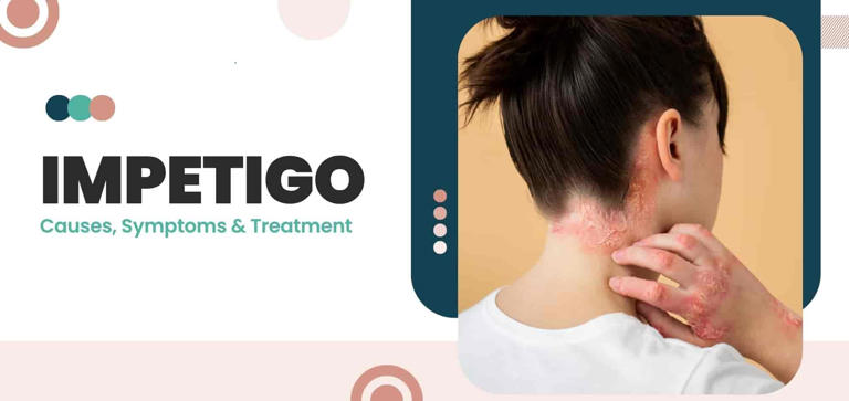 Impetigo: Causes, symptoms, and effective treatment options
