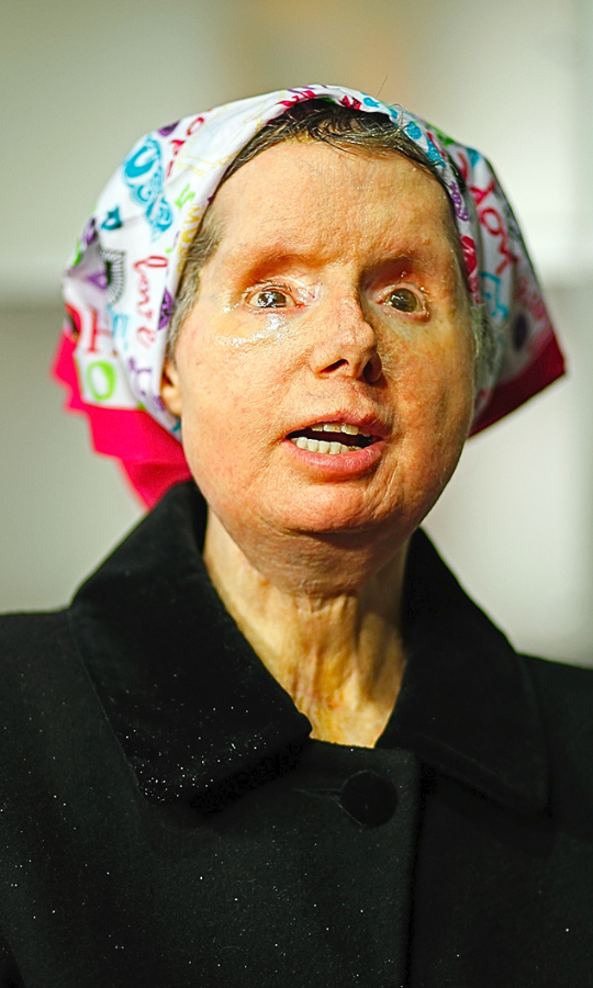 Her face was ripped off by a monkey