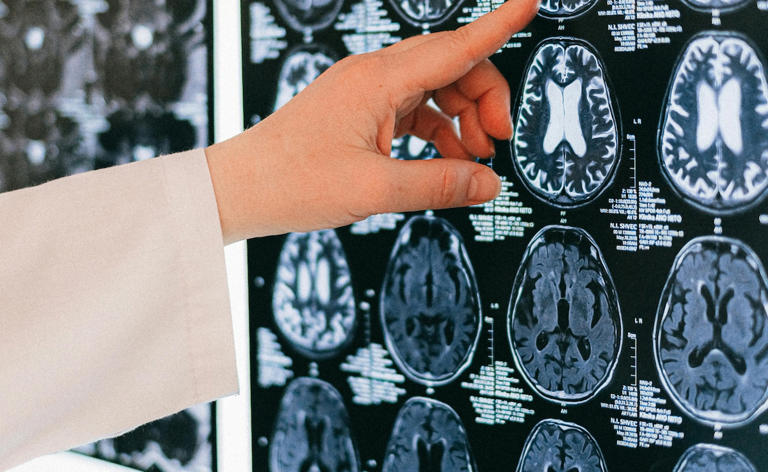 Study finds smoking weed and tobacco accelerates brain shrinkage