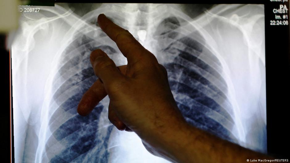Undiagnosed TB poses challenge for South Africa, Mozambique