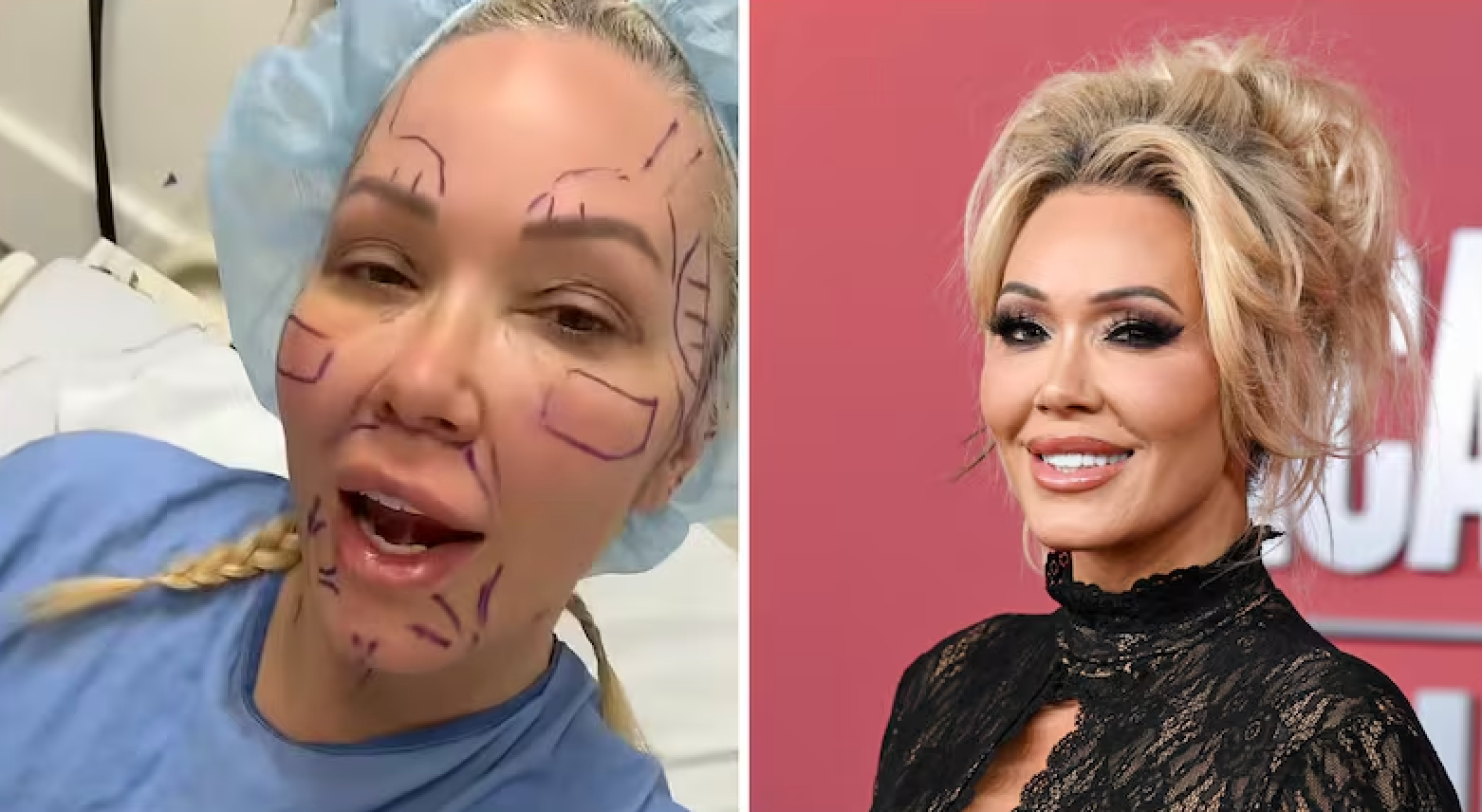 Jelly Roll’s wife unveils plastic surgery results in before & after photos