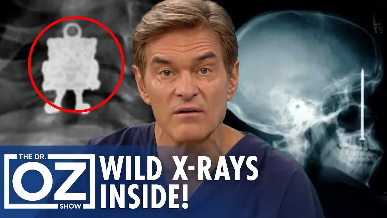 Extreme X-rays: Toy swallow test & the FART score | Oz Health