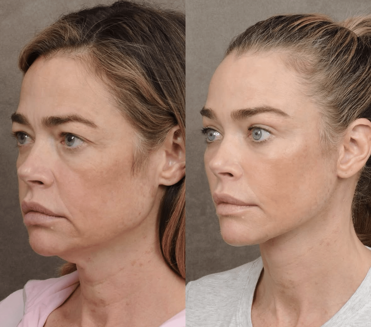 Denise Richards agrees: The results of her facelift are 'shocking.' See ...
