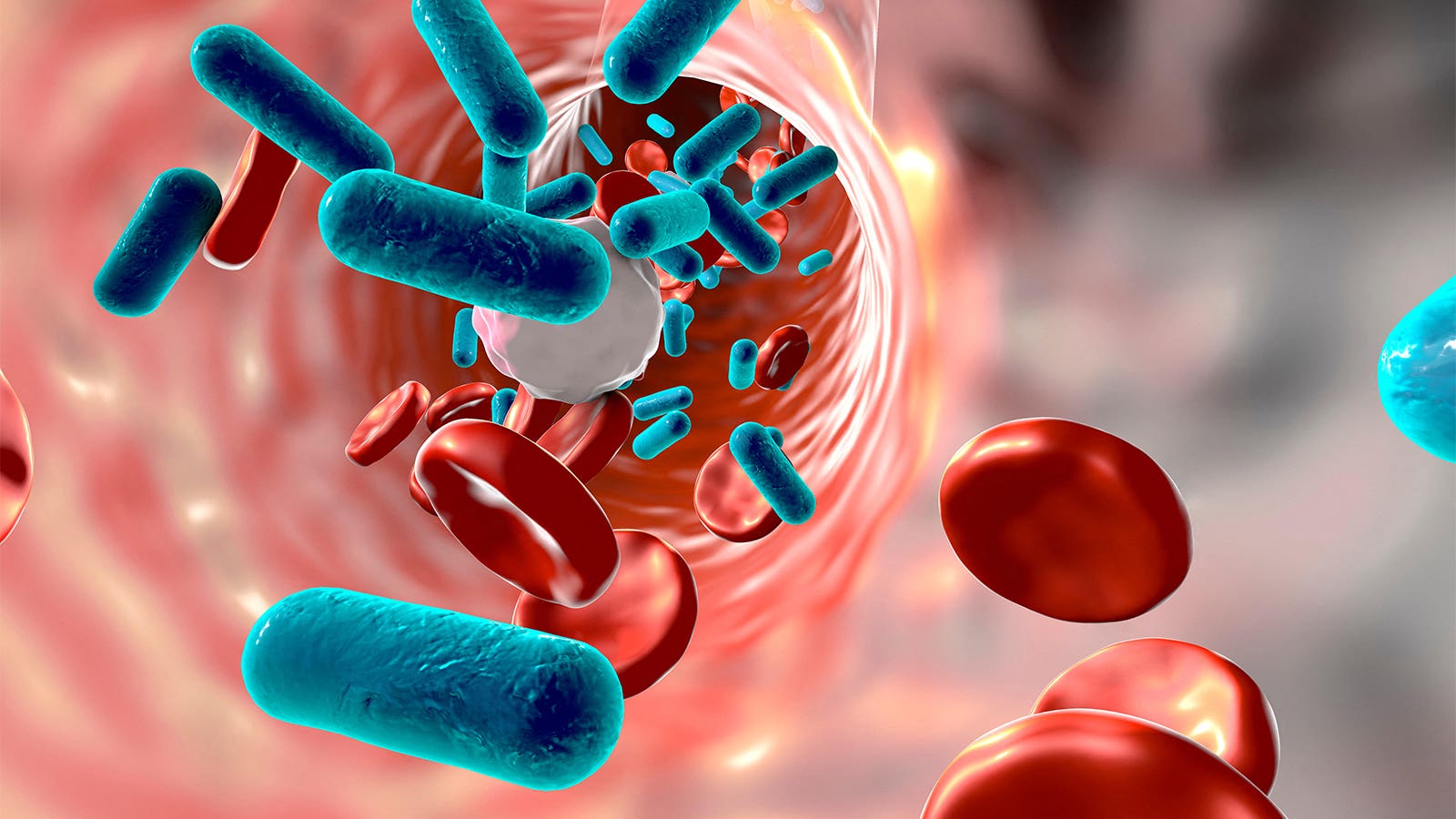 Sepsis rates are up. Here's what might explain why.