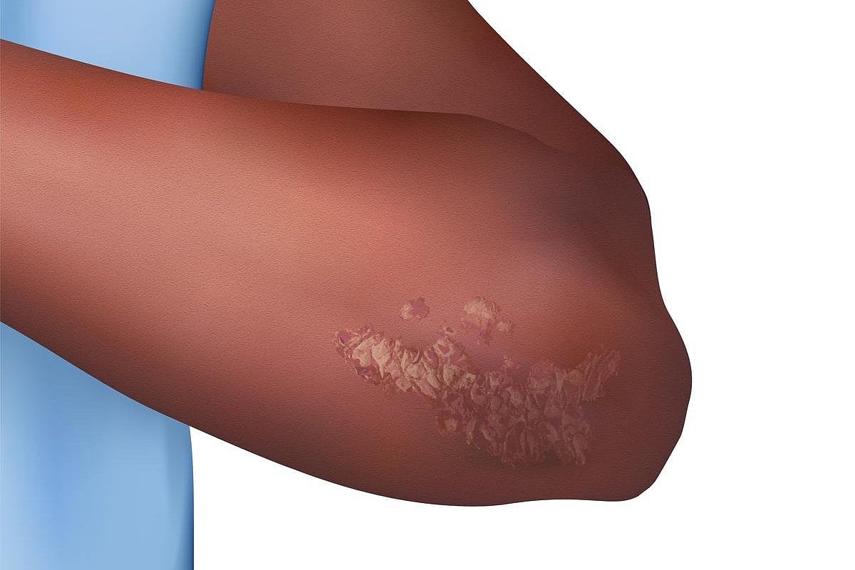 FDA approves Icotyde for moderate-to-severe plaque psoriasis