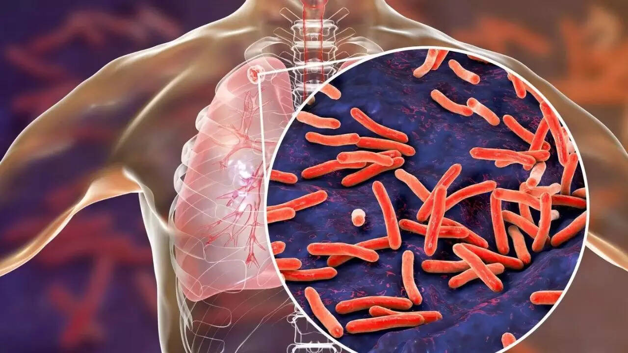 TB remains India’s biggest infectious killer, but mass screening push ...