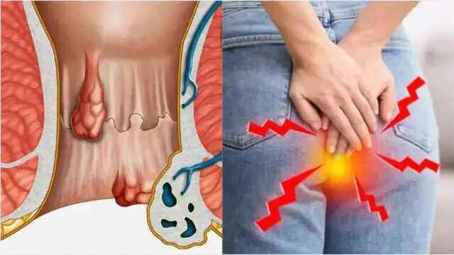 Effective Ayurvedic remedies for hemorrhoids: Quick relief techniques