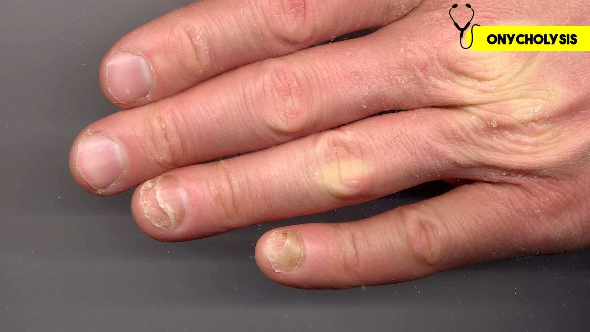 19 visible signs of an overactive thyroid you shouldn’t ignore
