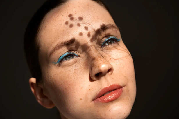 Why Indian skin faces more dark spots in summer