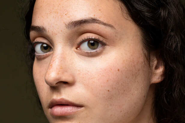 Why Indian skin faces more dark spots in summer