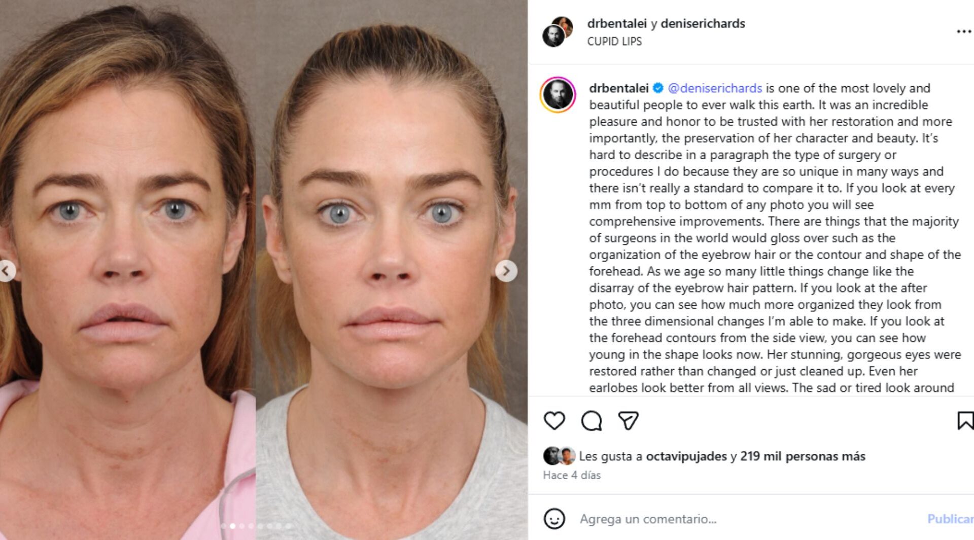 Denise Richards debuts facelift transformation