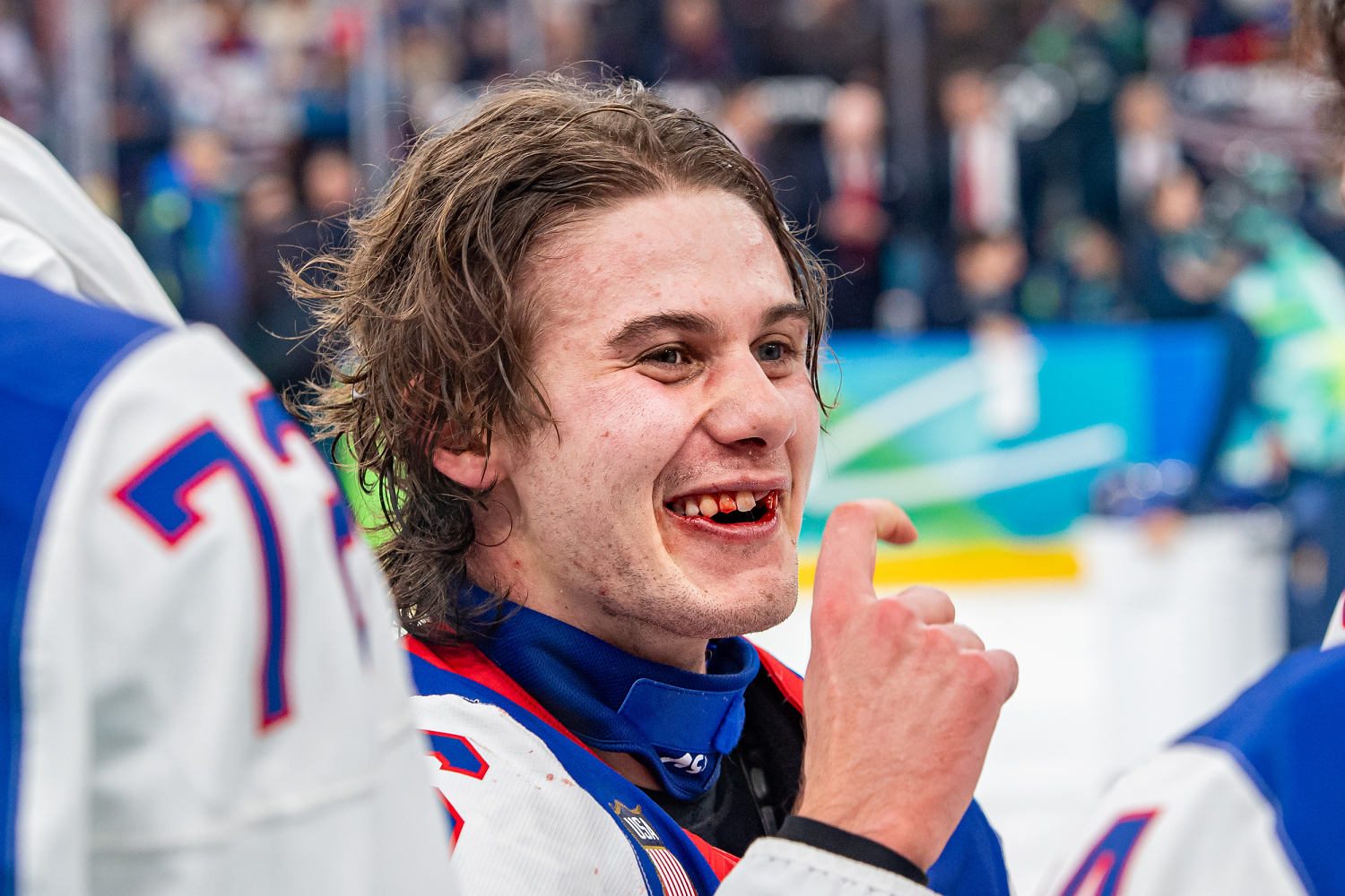 US Olympic hockey hero Jack Hughes finally fixes teeth broken in gold ...
