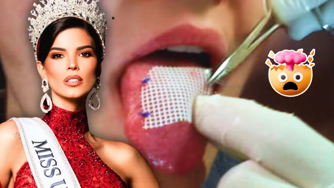 Una extraña cirugía en la lengua que se puso de moda