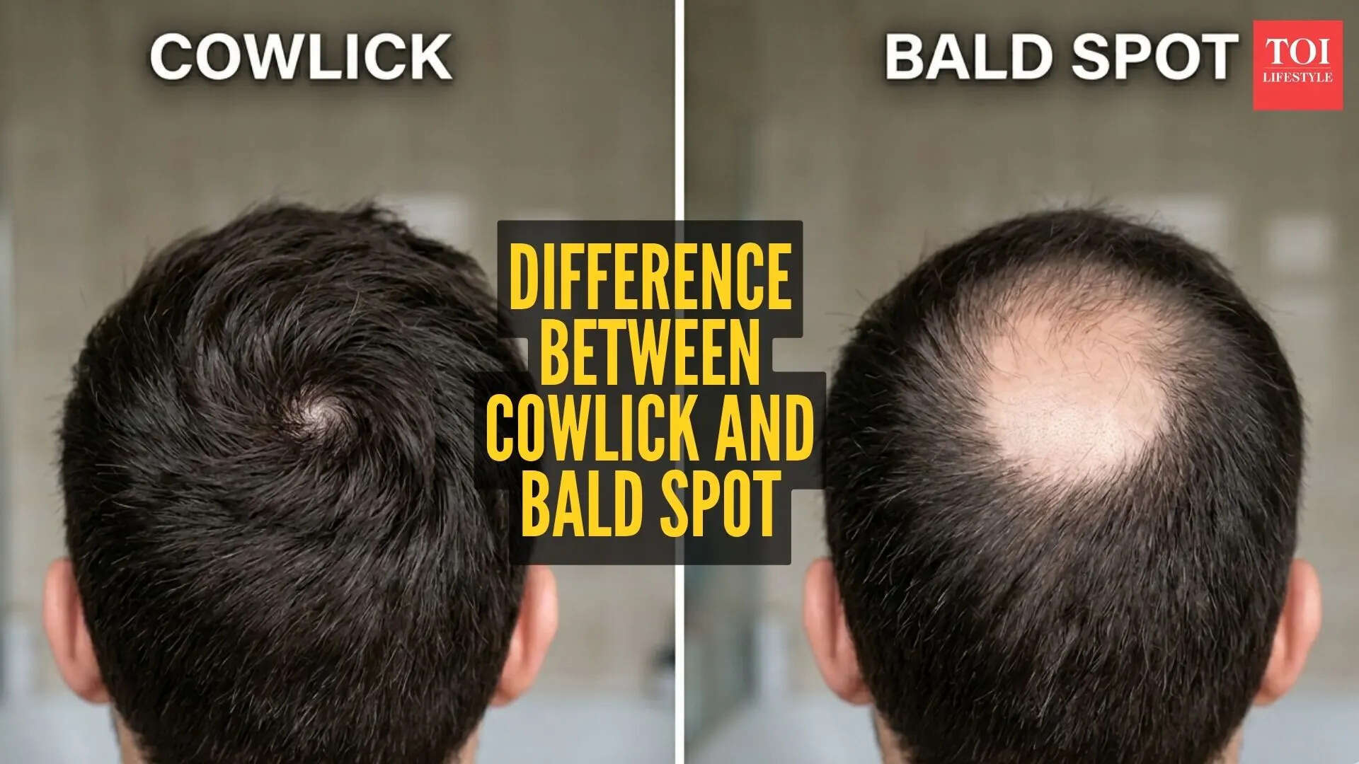 How to differentiate between a cowlick and bald spot
