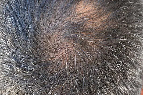 How to differentiate between a cowlick and bald spot