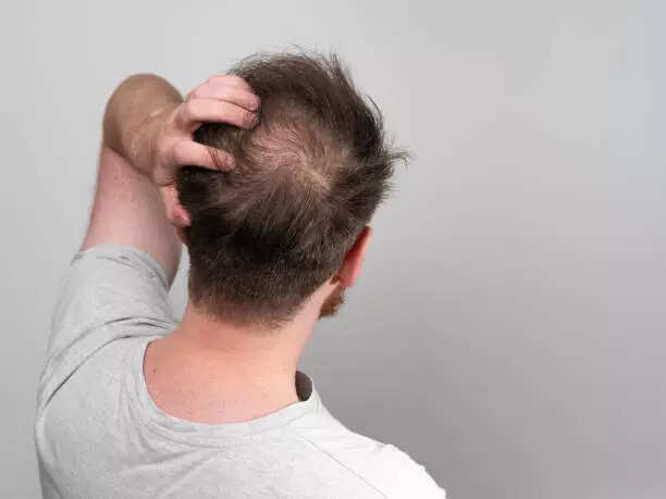 How to differentiate between a cowlick and bald spot