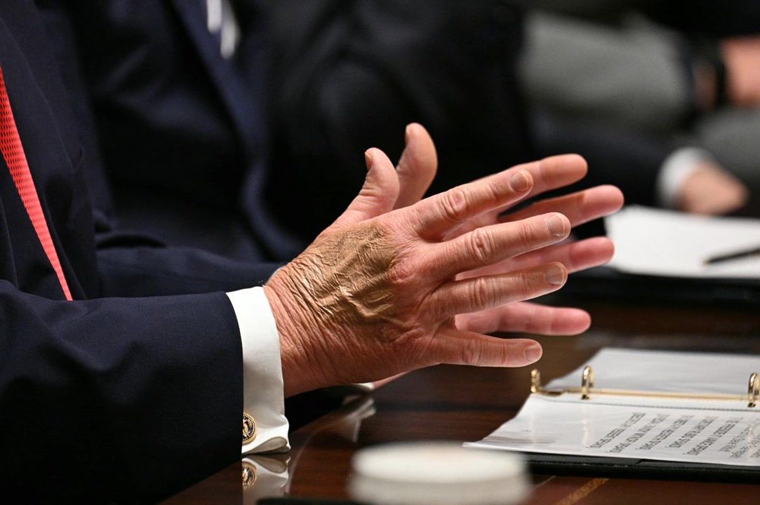 Donald Trump spotted with two fresh bruises after disappearing for 24 hours
