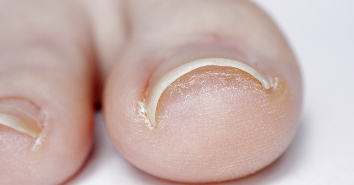 Why do toenails curl and dig into the skin as we get older?