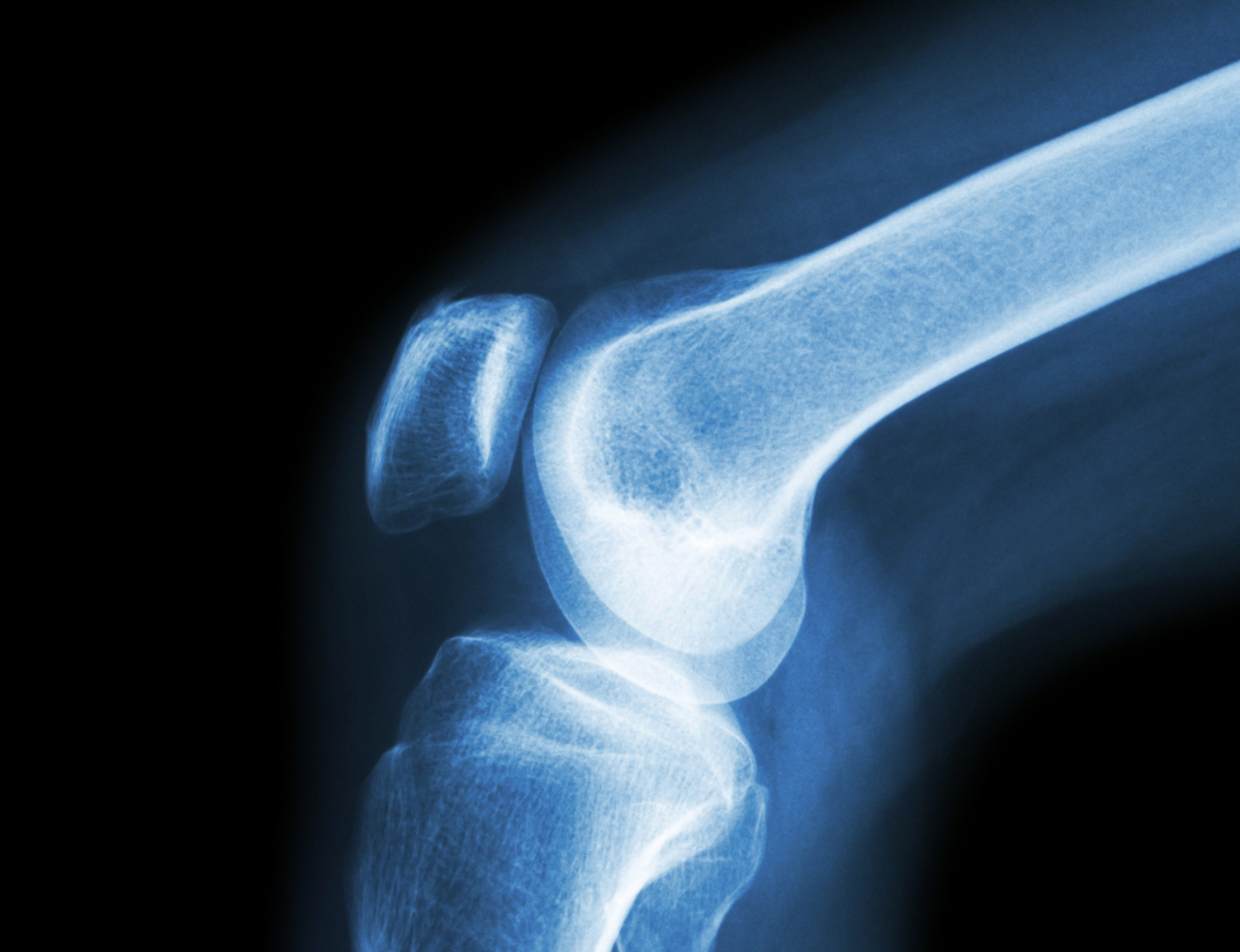 The challenges of living with arthritis