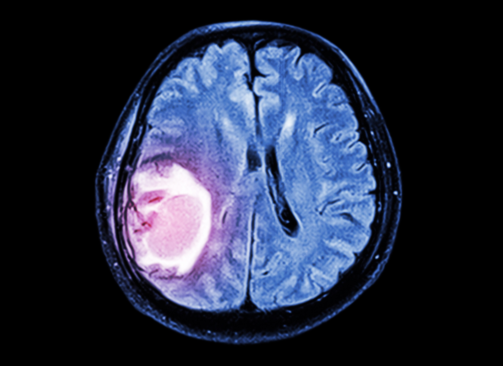 The destructive effects of brain cancer