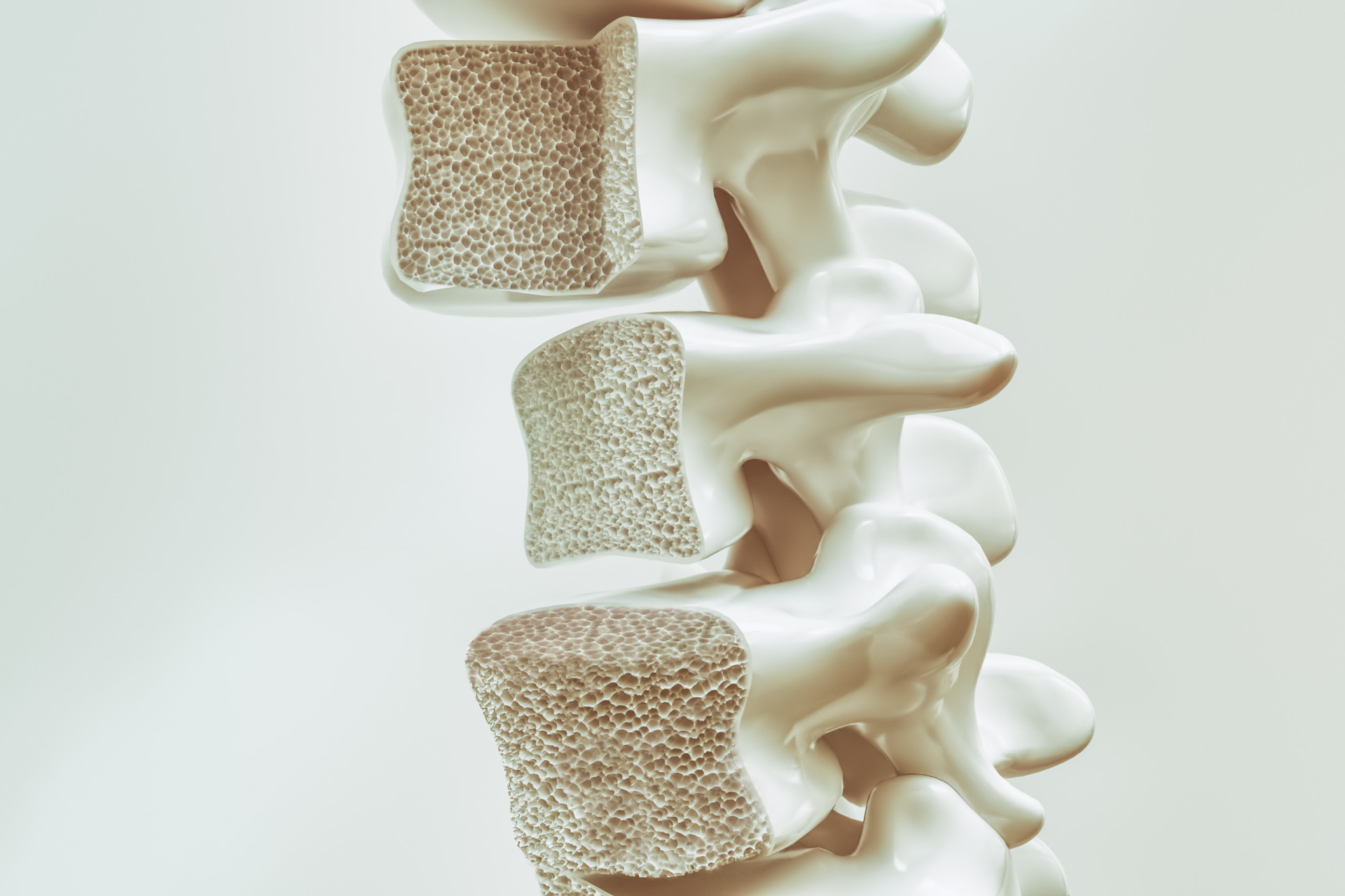 Osteoporosis: The silent disease