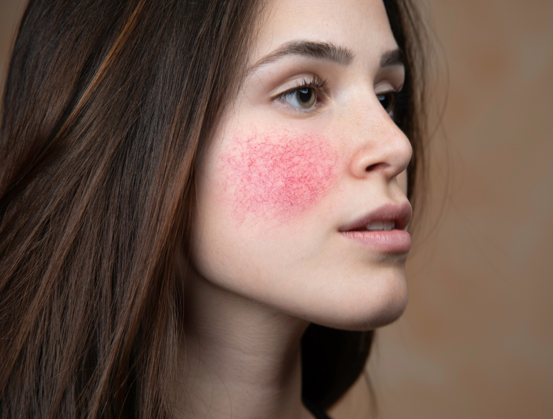 Comment Faire Face à La Maladie De La Peau Appelée Rosacée