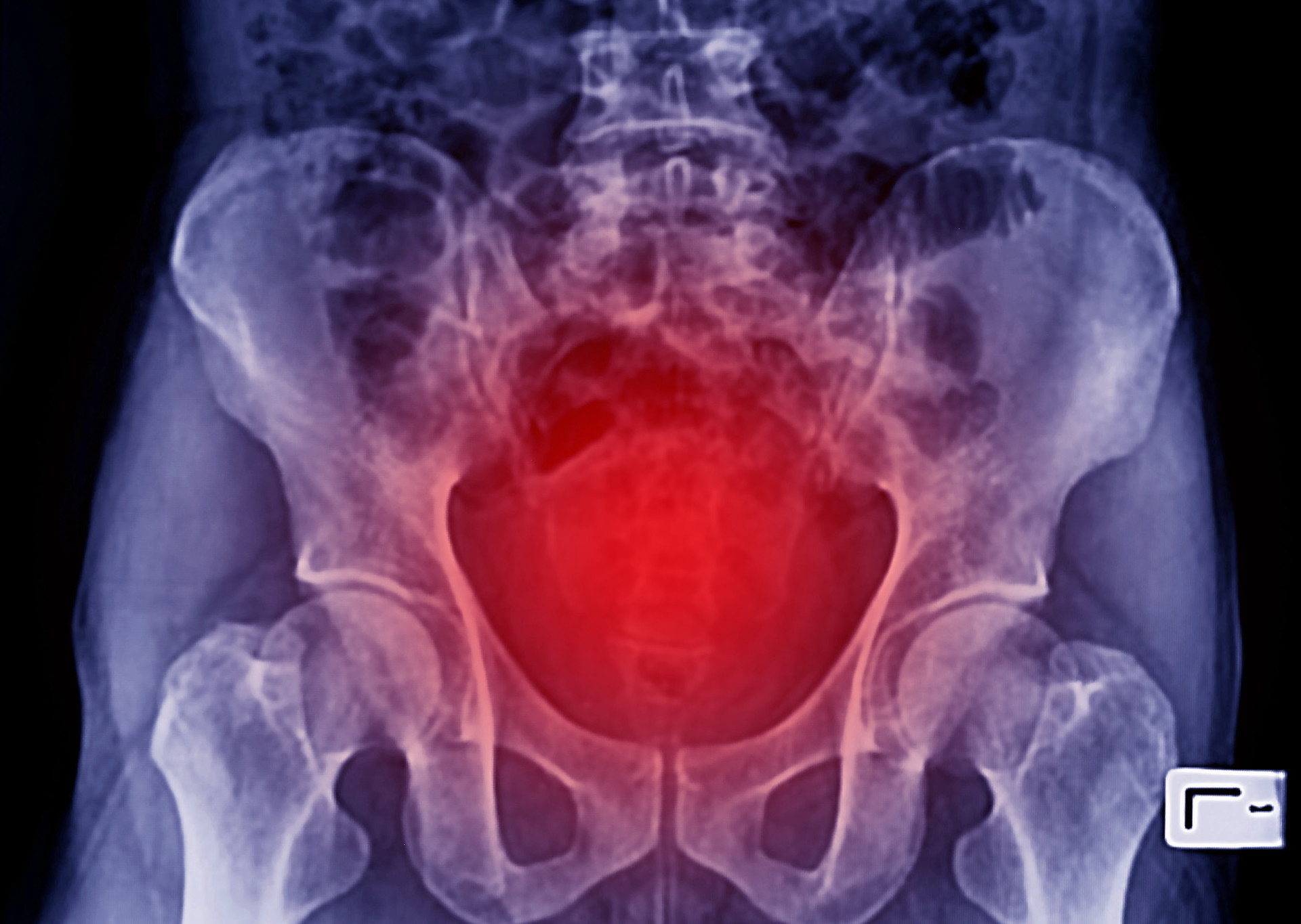 endometriosis-the-disease-affecting-millions-of-women