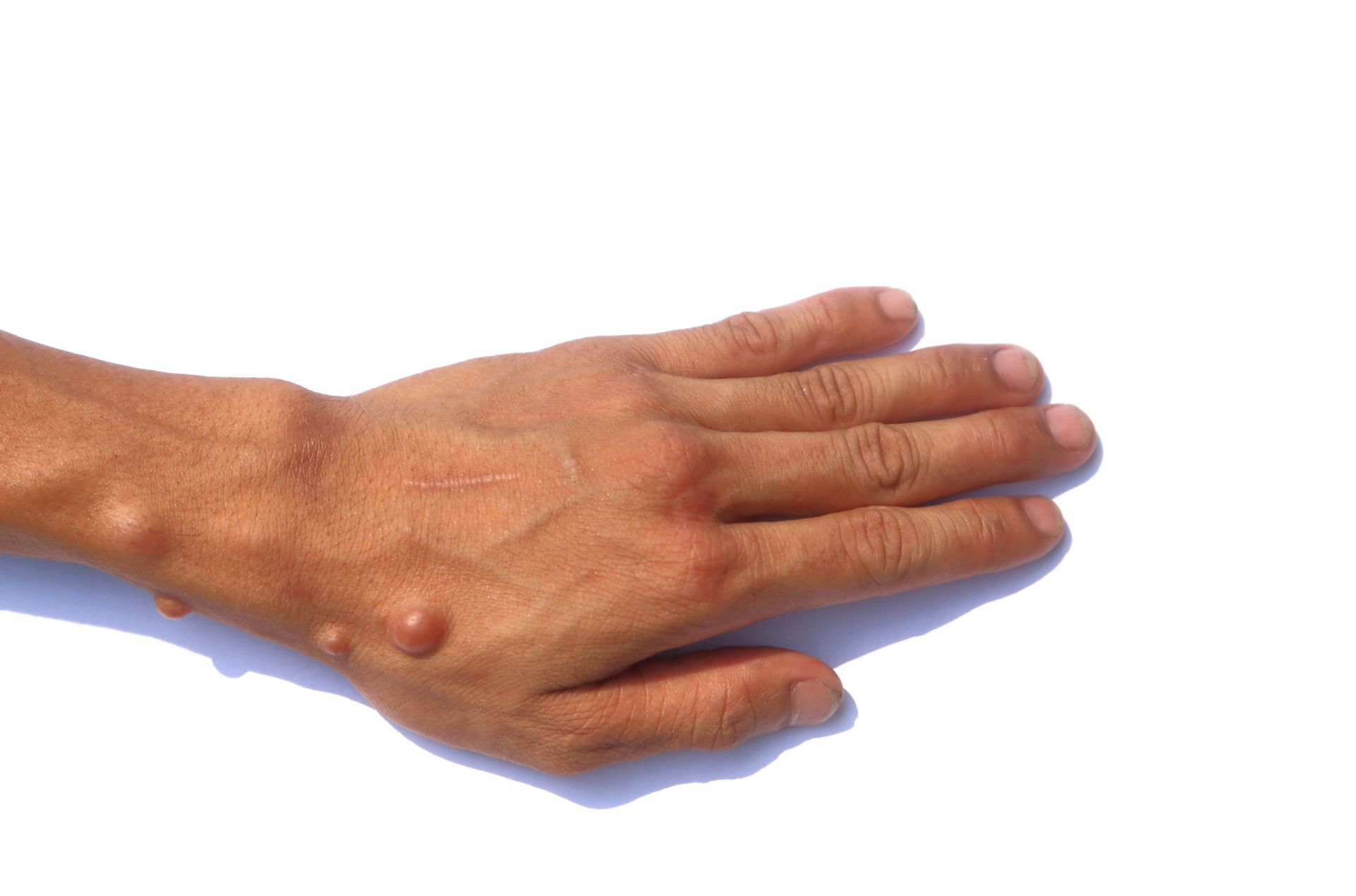 What exactly is neurofibromatosis?