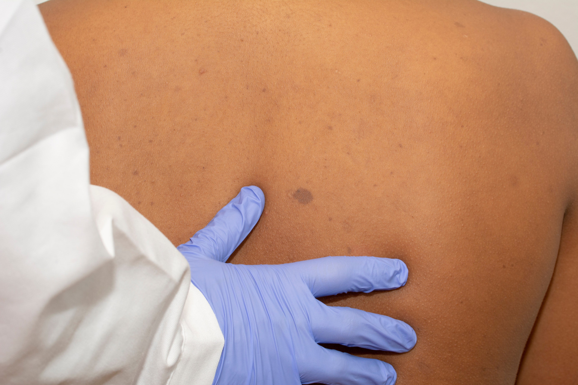 What exactly is neurofibromatosis?