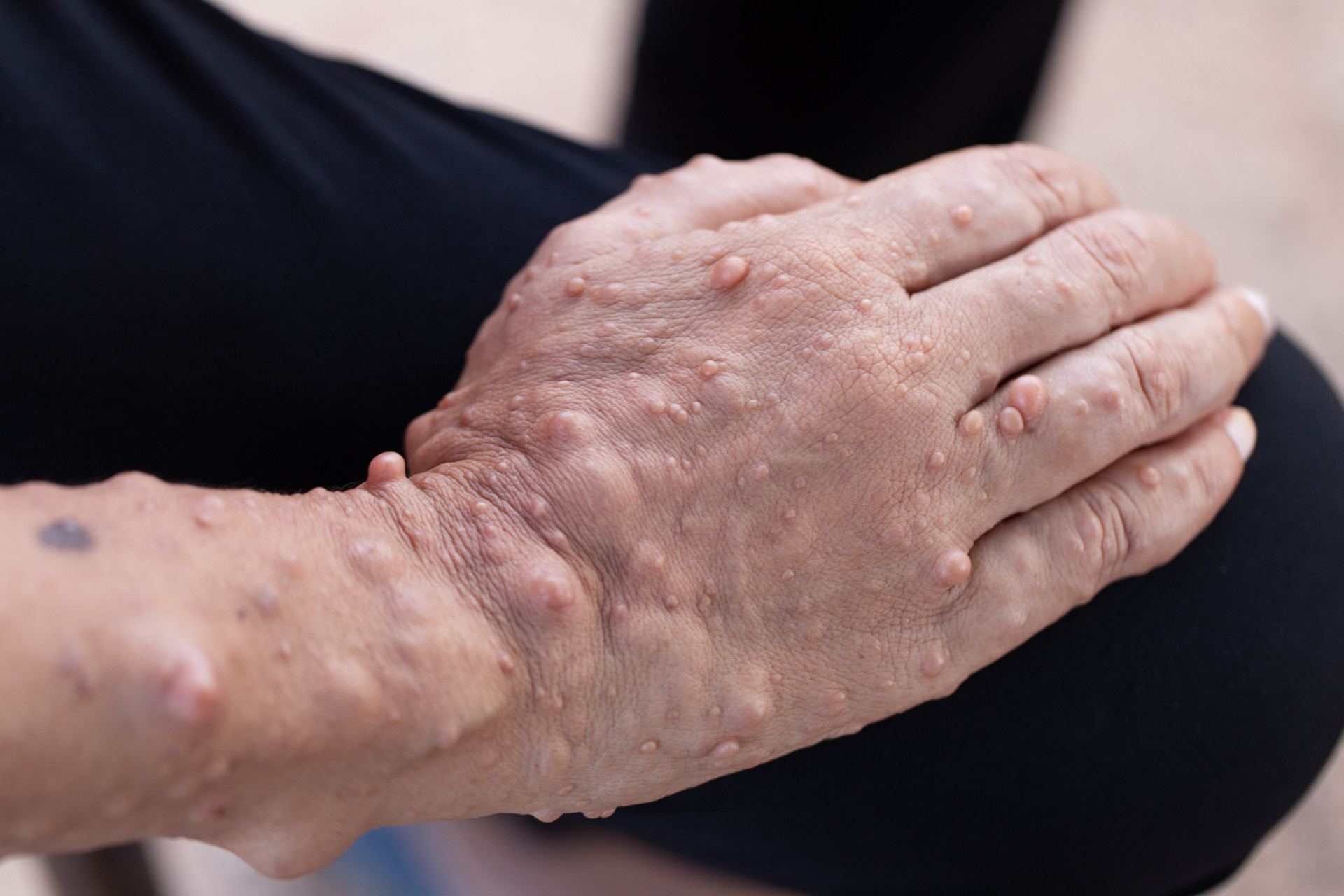 What exactly is neurofibromatosis?