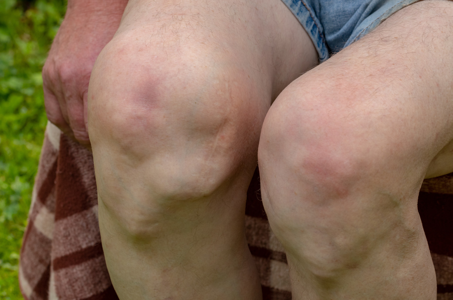 What exactly is neurofibromatosis?
