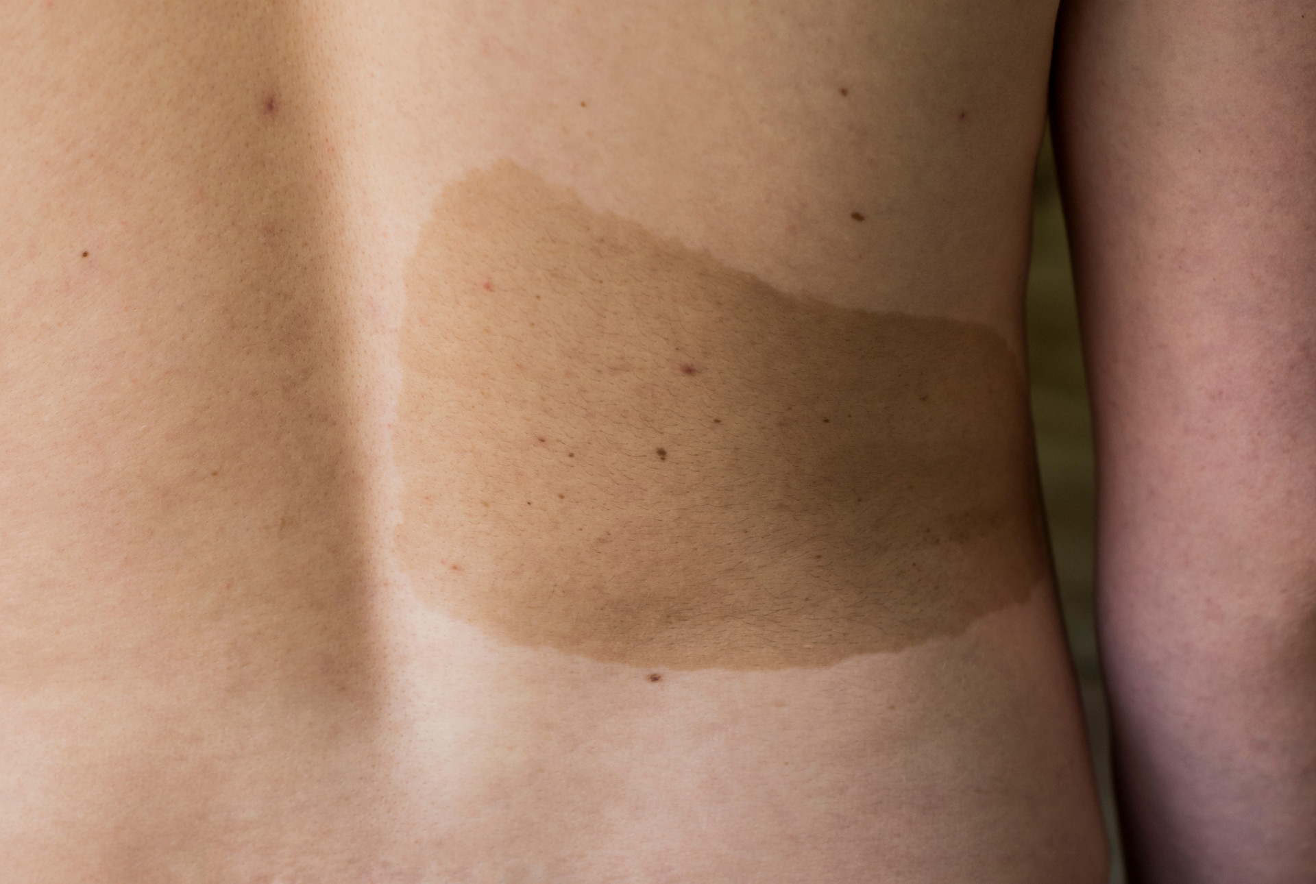 What exactly is neurofibromatosis?