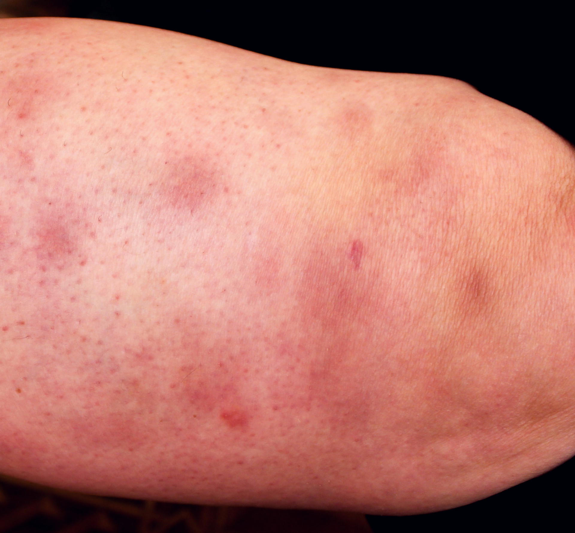 Sarkoidose: Wie gefährlich ist diese Erkrankung?