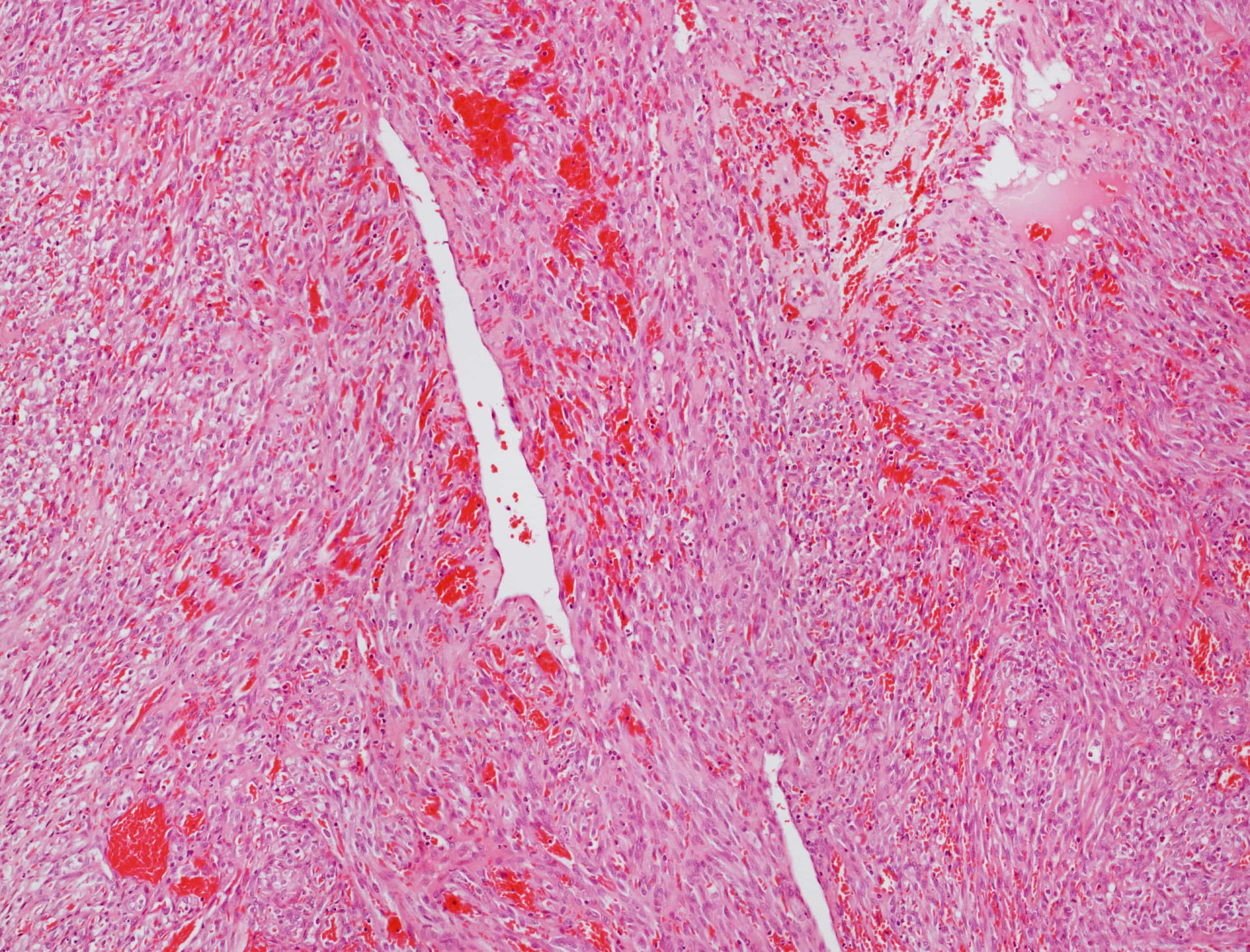Tout savoir sur le sarcome : une introduction à ce type de cancer