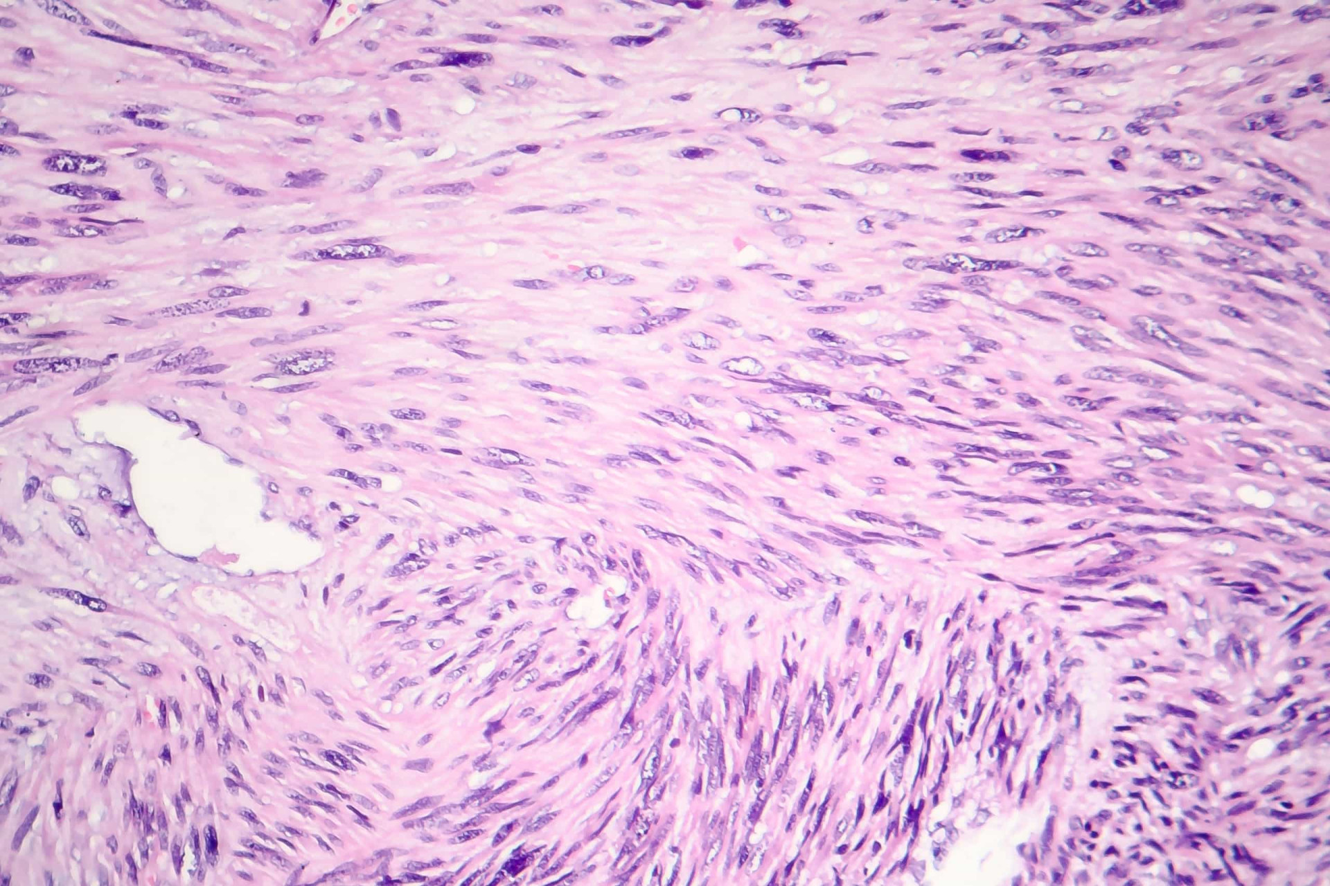 Tout savoir sur le sarcome : une introduction à ce type de cancer