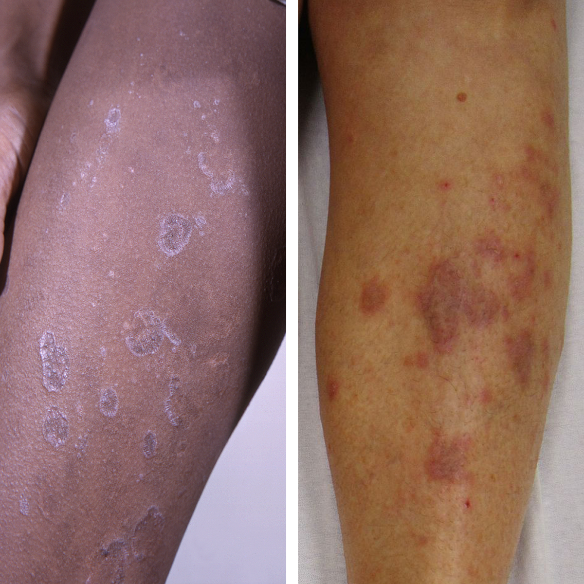 These Pictures Will Help You Identify the Most Common Skin Rashes
