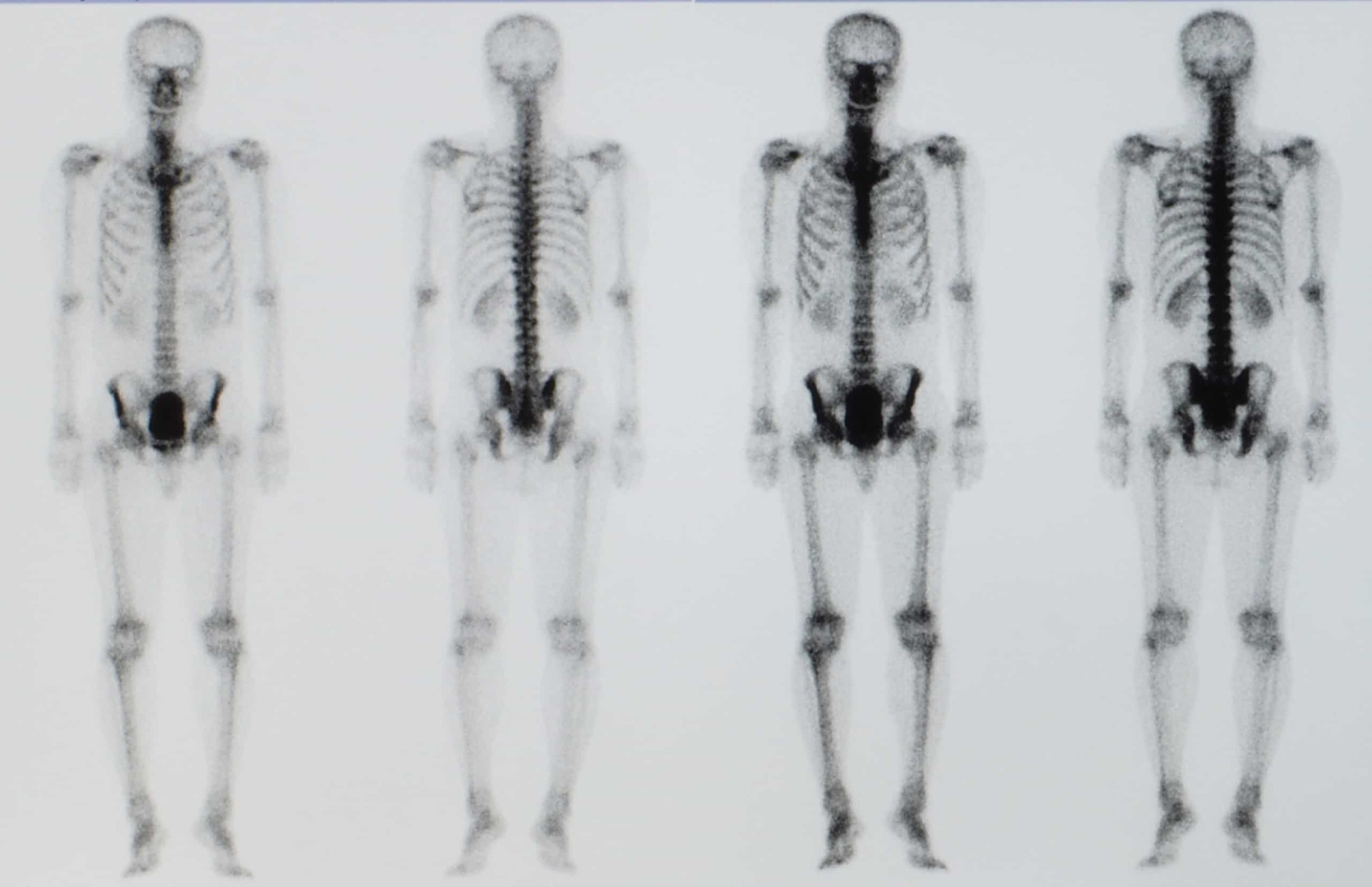 Tout savoir sur le sarcome : une introduction à ce type de cancer