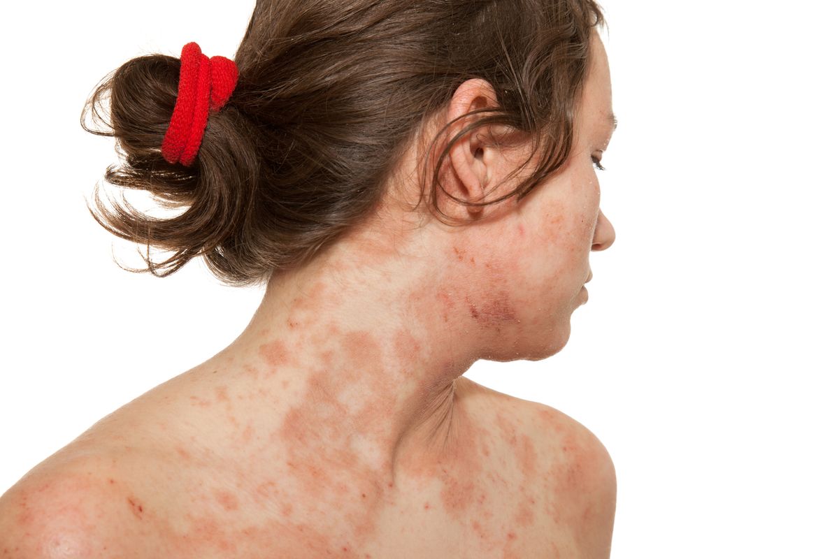 These Pictures of Skin Rashes Will Help You Quickly Identify Them