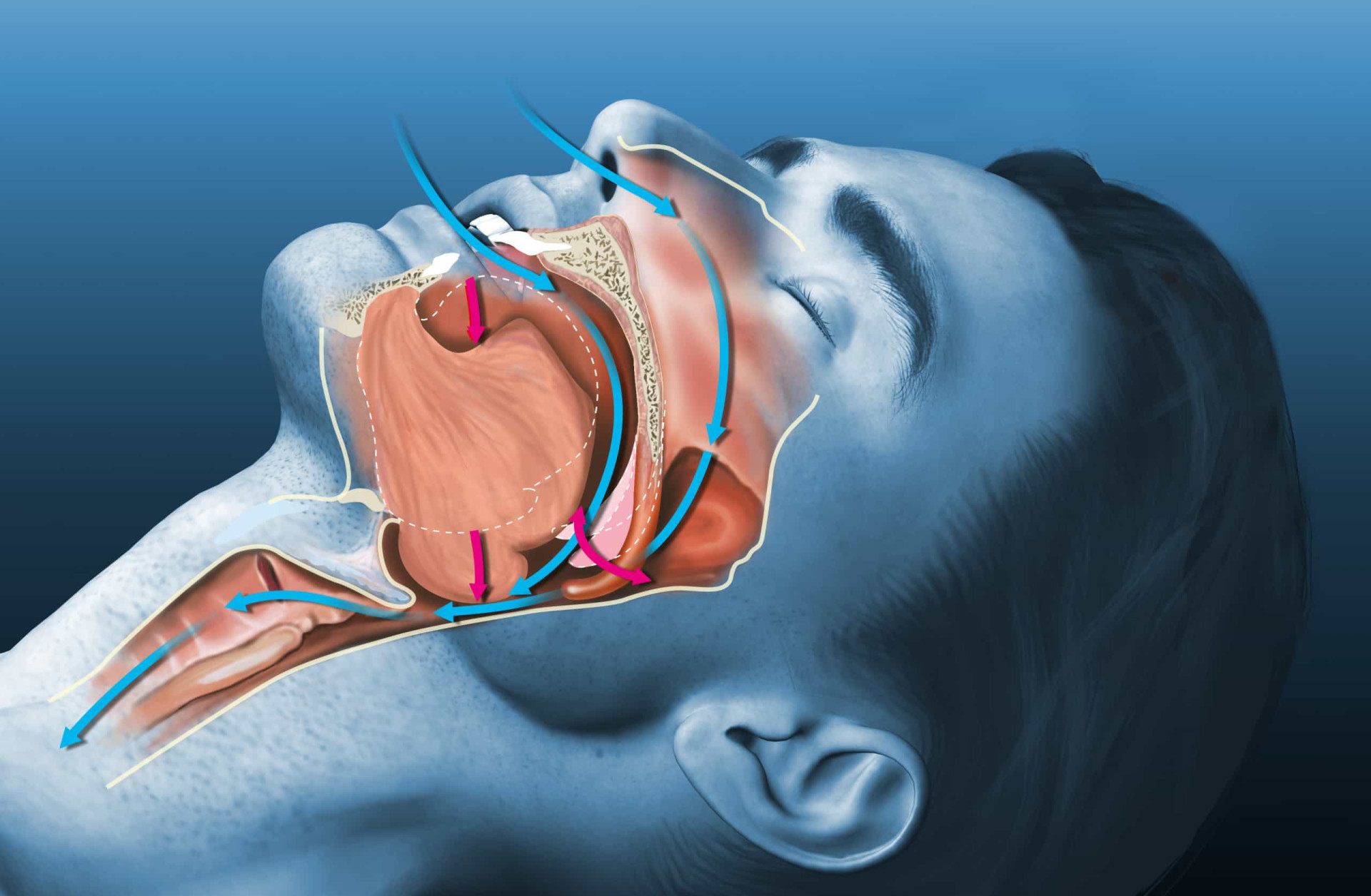 Sleep apnea: the sleep condition that can kill